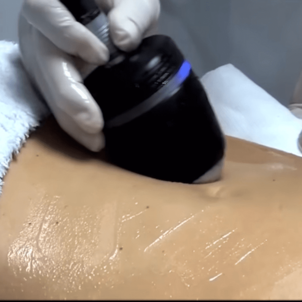 Guía completa de tratamientos corporales para eliminar celulitis, flacidez y grasa localizada ...